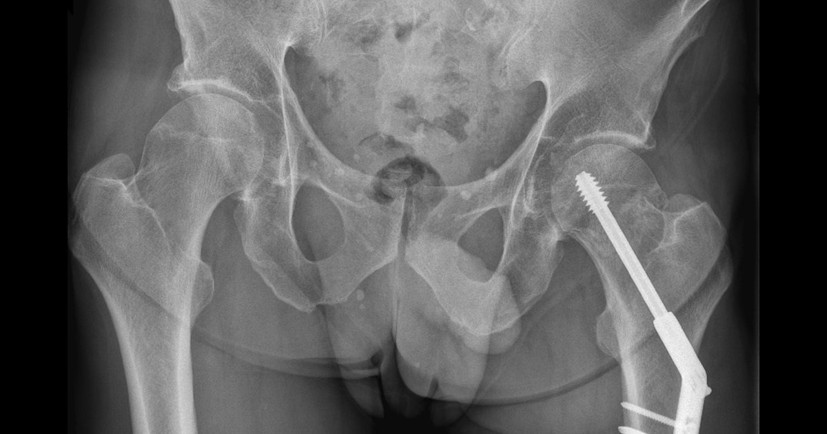 Nieuw onderzoek: een gebroken heup opereren is niet altijd de beste ...