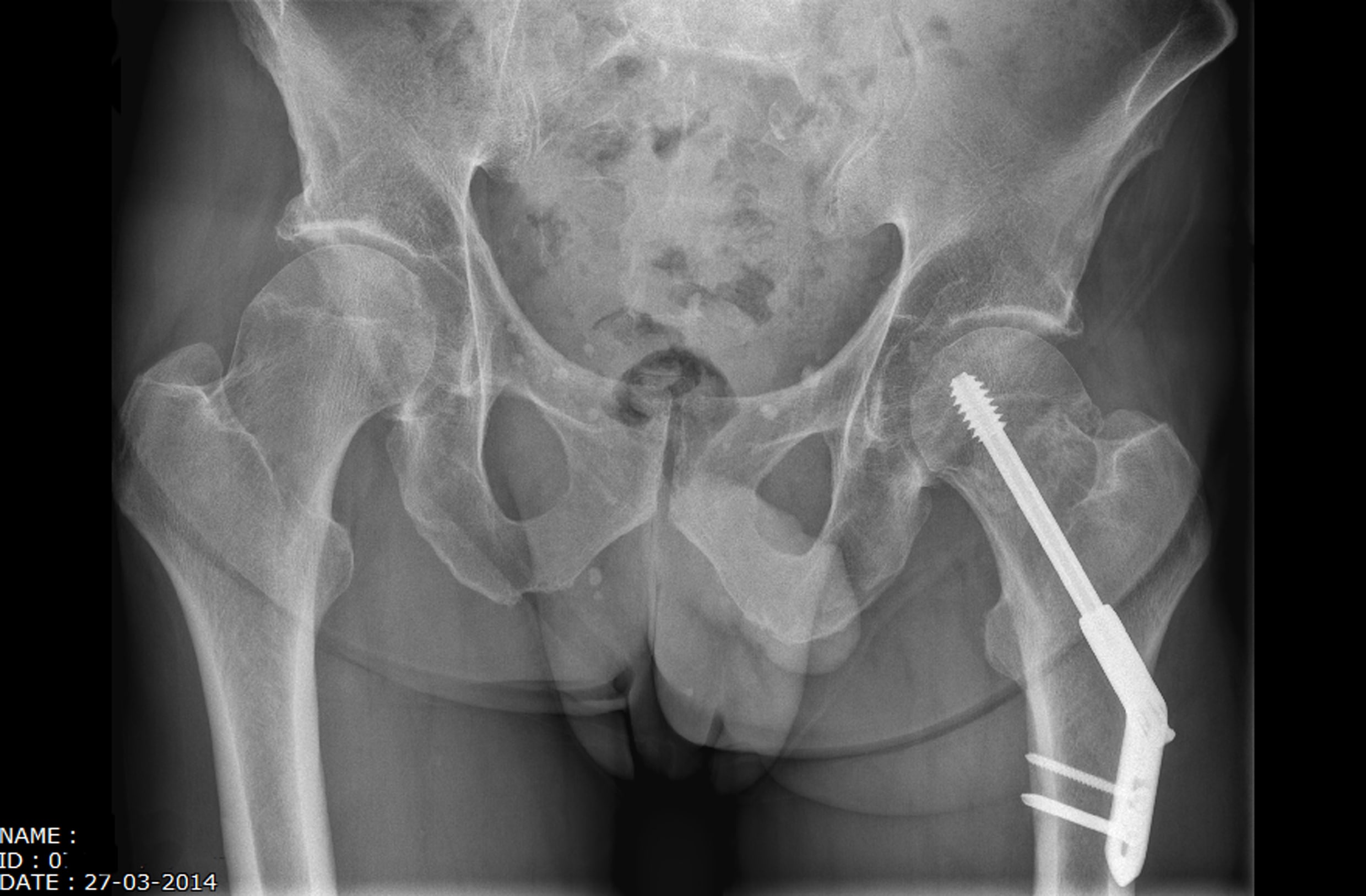 Nieuw onderzoek: een gebroken heup opereren is niet altijd de beste ...